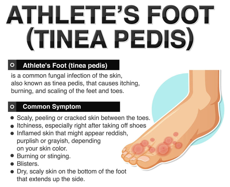 Complete Guide to Treating Athlete’s Foot | Mirpharma